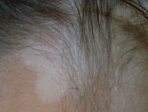 白癜风图像| DermNet新西兰