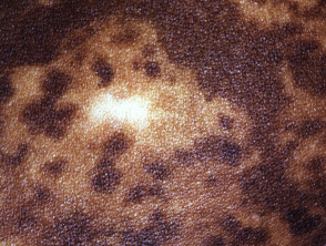 白癜风图像| DermNet新西兰