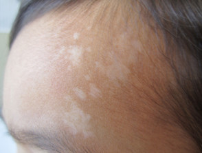 白癜风图像| DermNet新西兰