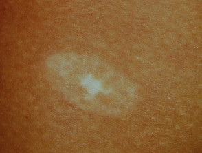 白癜风图像| DermNet新西兰