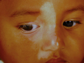 白癜风图像| DermNet新西兰