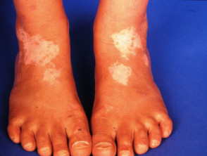 白癜风图像| DermNet新西兰