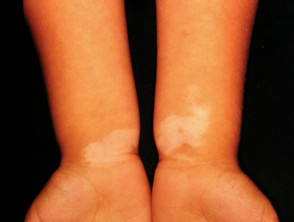 白癜风图像| DermNet新西兰