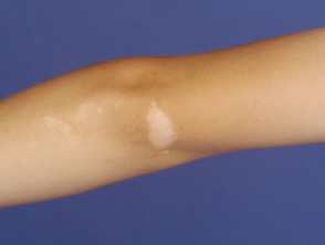 白癜风图像| DermNet新西兰