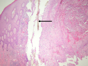 Pilonidal Sinus病理学|Dermnet NZ.